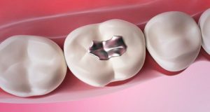 Cómo quitar empastes de amalgama correctamente